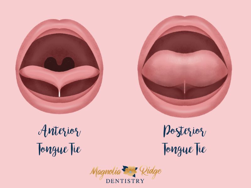 Tongue & Lip Tie Release in Melissa, TX | Magnolia Ridge Dentistry